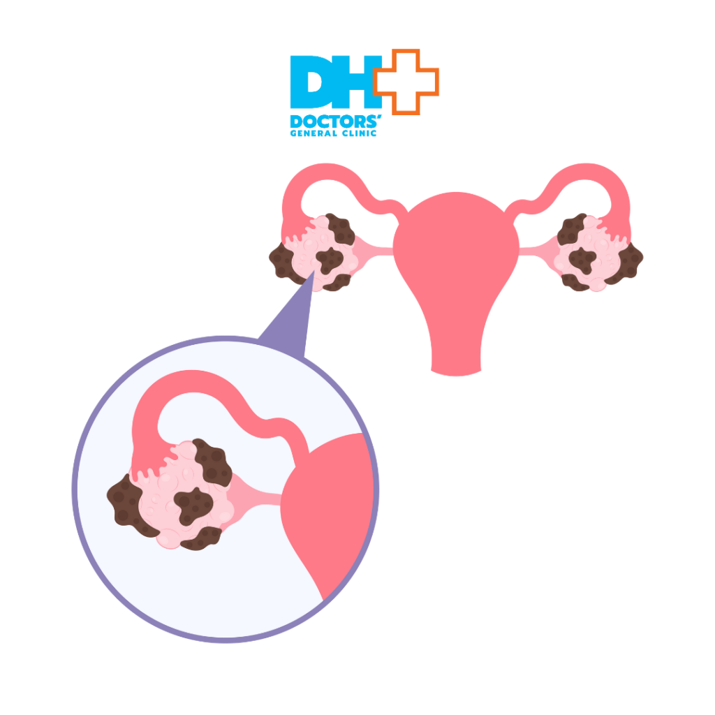 Καρκίνος Ωοθηκών - Doctors' General Clinic